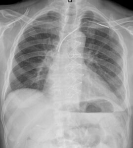 Abandoned Intravascular Pacer and ICD Leads - MR IMPLANT