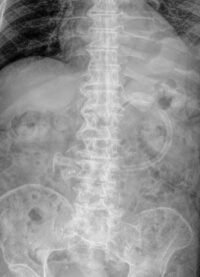 Gastrostomy Tube - MR IMPLANT