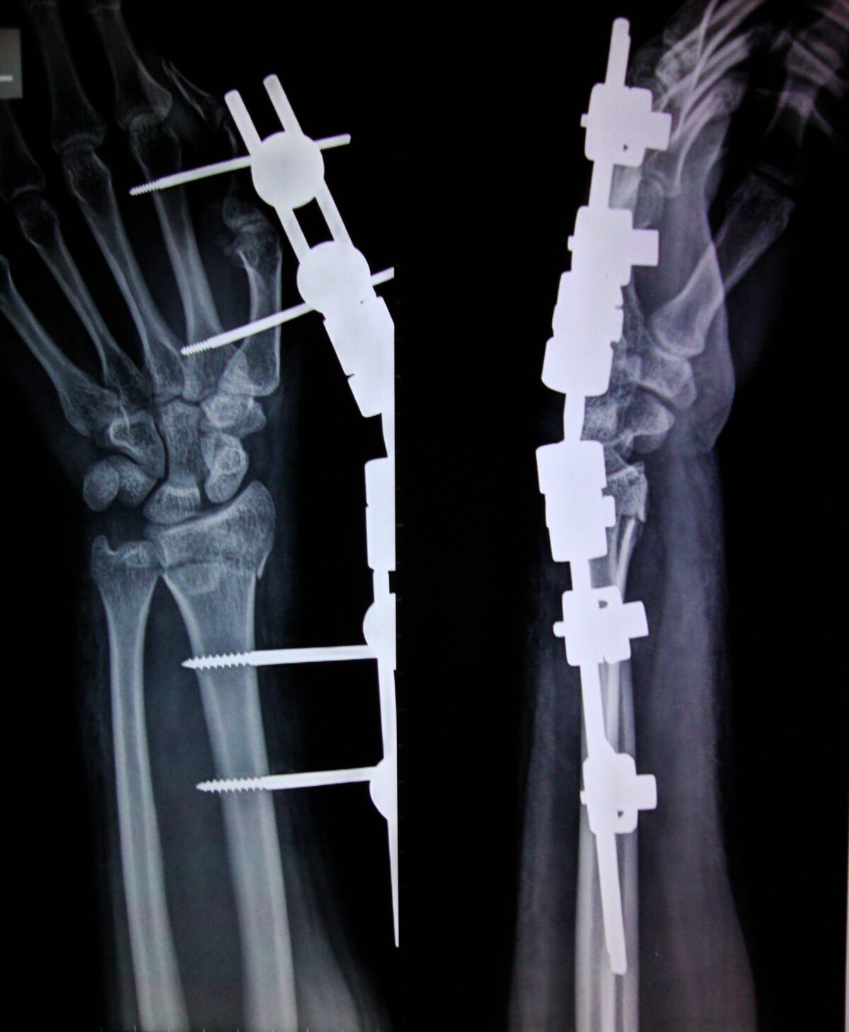 External Orthopedic Fixation Devices - MR IMPLANT
