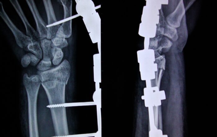 Orthopedic Archives - MR IMPLANT