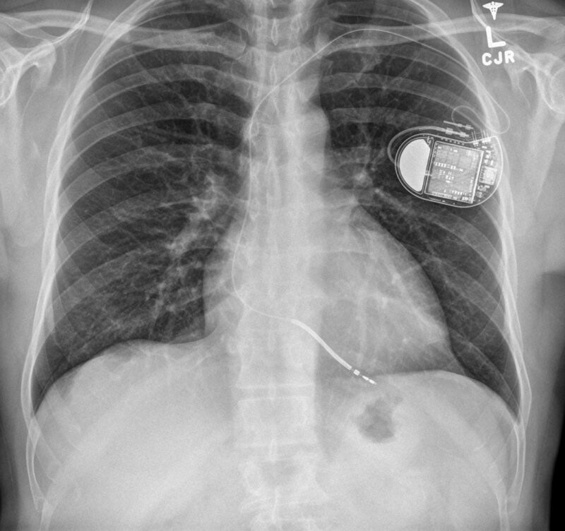 ICD (Implantable Cardioverter Defibrillator) - MR Compatible - MR IMPLANT
