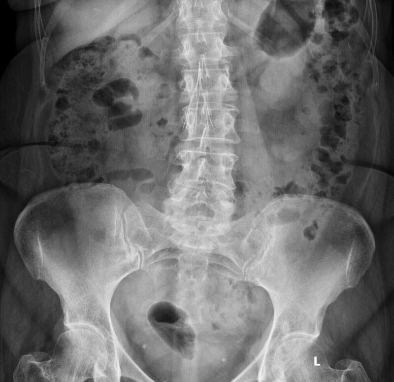 Inferior Vena Cava (IVC) Filter - MR IMPLANT
