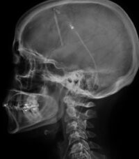 Ventriculoperitoneal (VP) Shunt Catheters - MR IMPLANT
