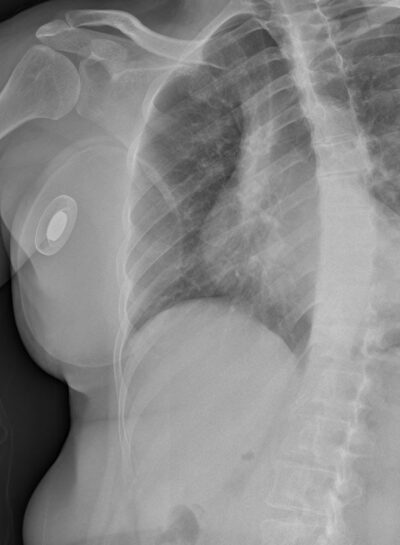 Breast Implants/Spacers/Tissue Expanders - MR IMPLANT