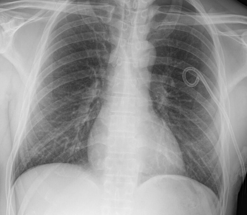 Chest Tube - MR IMPLANT