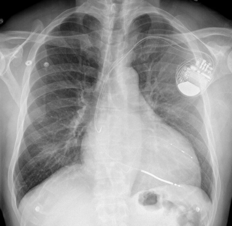 Cardiac Resynchronization Device - MR IMPLANT