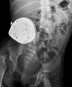 Medtronic Synchromed Implantable Infusion Pump - MR IMPLANT