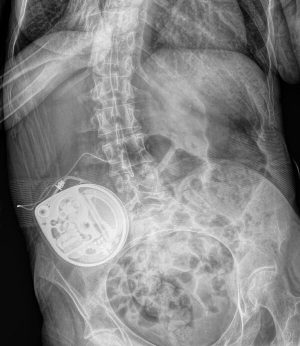 Prometra Implantable Infusion Pump - MR IMPLANT