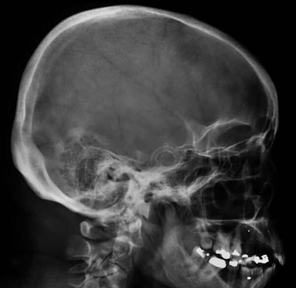 Intracranial Vascular Stents - MR IMPLANT
