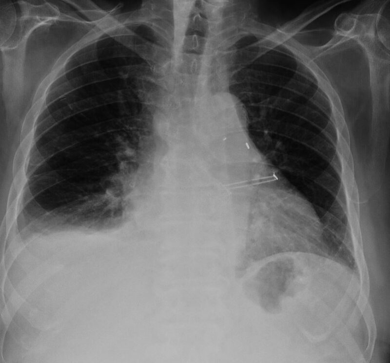 Left Atrial Appendage Clip - MR IMPLANT