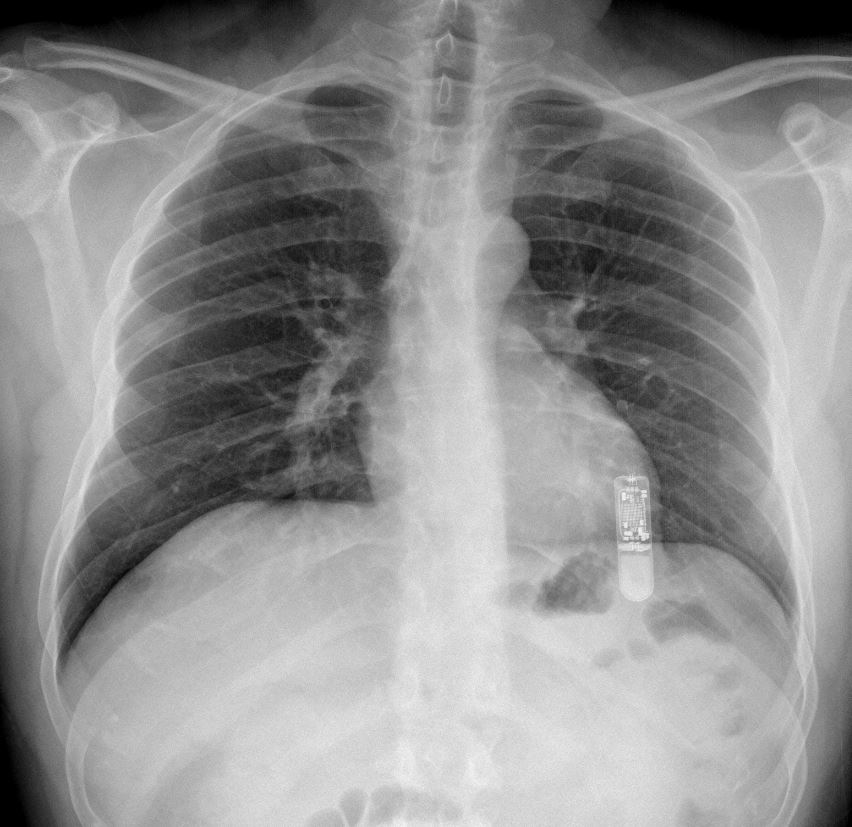 Implanted Cardiac Event Recorder Loop Recorder MR IMPLANT Implanted Cardiac Event Recorder Loop Recorder MR IMPLANT