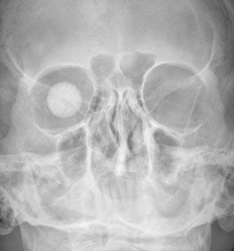 Orbital and Ocular Prostheses - MR IMPLANT