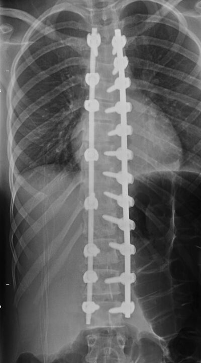 Orthopedic Hardware - MR IMPLANT