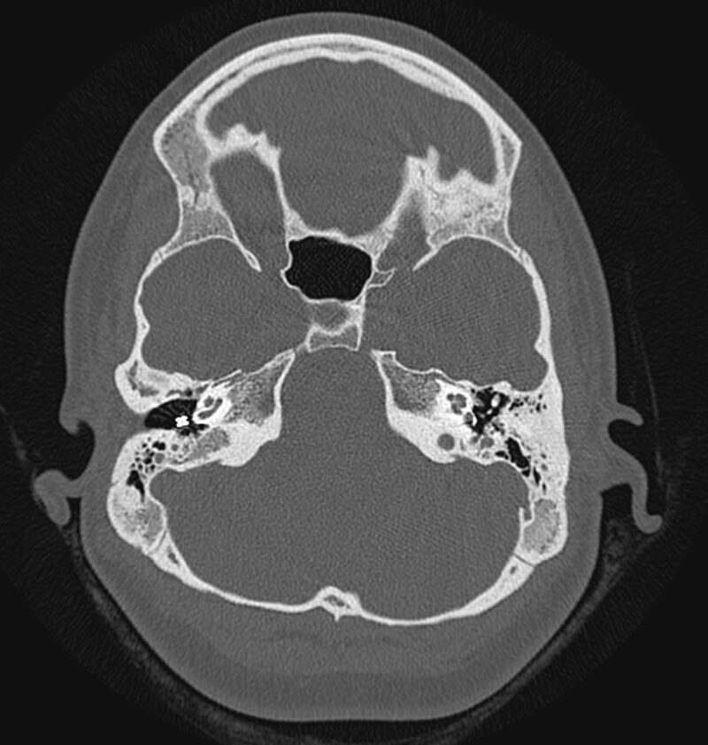 Ossicular Prosthesis - MR IMPLANT