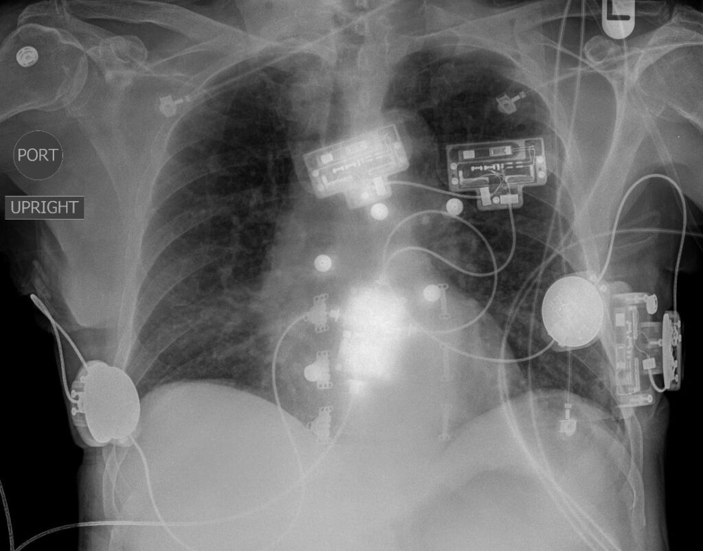 Patient Monitoring Equipment - MR IMPLANT