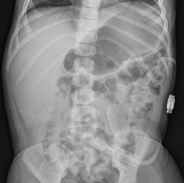 Peritoneal Dialysis Catheter - MR IMPLANT
