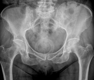 Pessary - MR IMPLANT