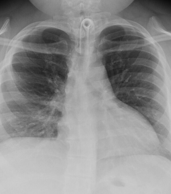 Tracheostomy tube - MR IMPLANT