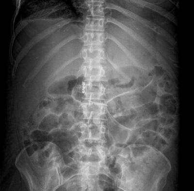 Vascular Embolization Coils / Embolization Materials - MR IMPLANT