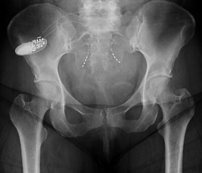 Sacral Neuromodulator - MR IMPLANT