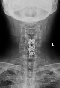 Spinal Fixation Hardware - MR IMPLANT