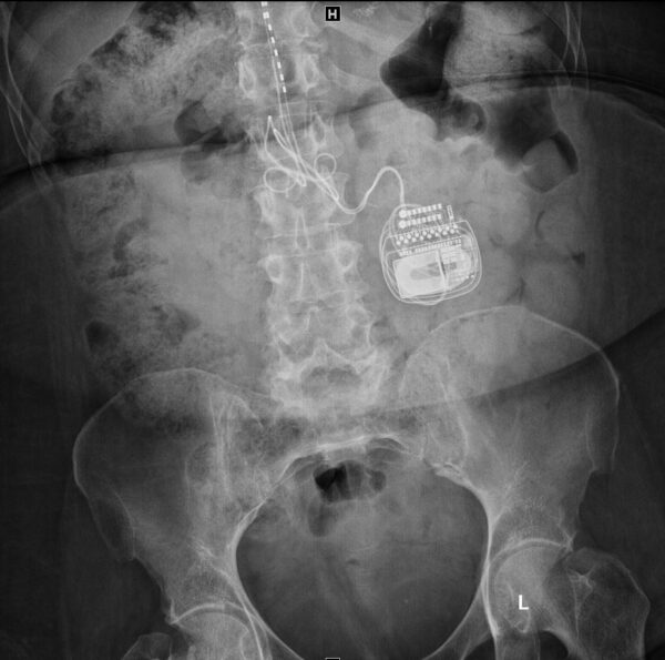 Spinal Stimulator - MR Conditional - MR IMPLANT