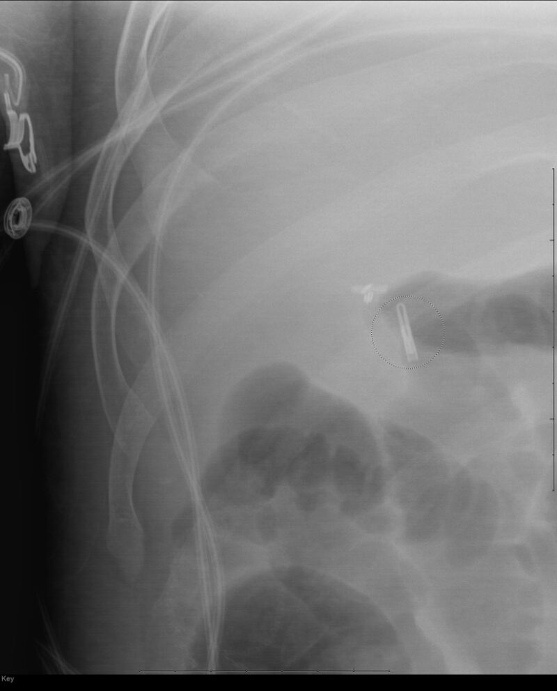 Hemostatic Endoscopy Clip - MR IMPLANT