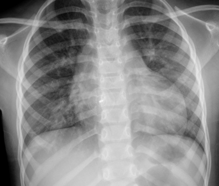 Atrial Septal Defect (ASD) Occlusion Device - MR IMPLANT