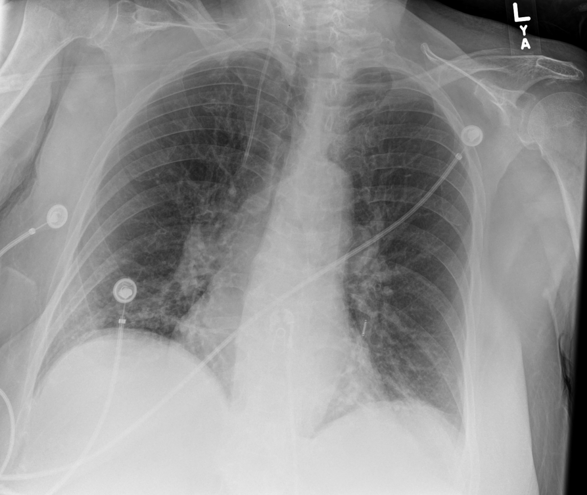 Implanted Pulmonary Artery Pressure Monitor - MR IMPLANT