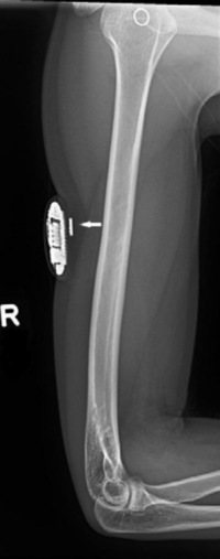 Eversense Implanted Continuous Glucose Monitor - MR IMPLANT