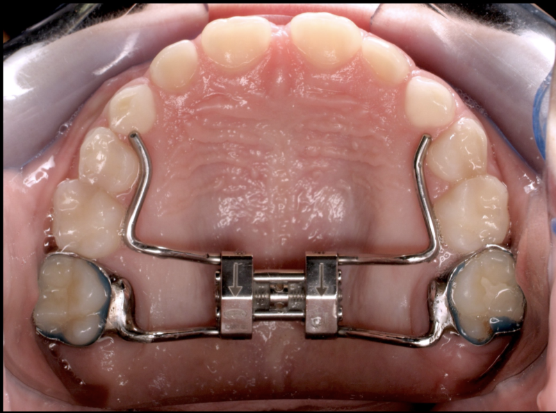 Palate Expander - MR IMPLANT