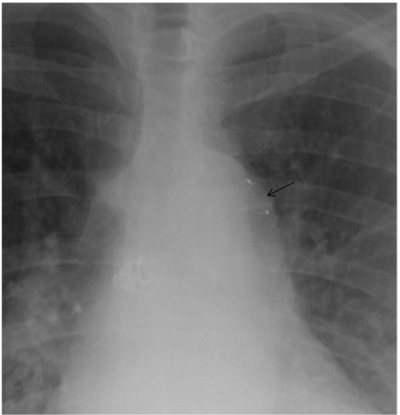 Amplatzer Vascular Plug - MR IMPLANT