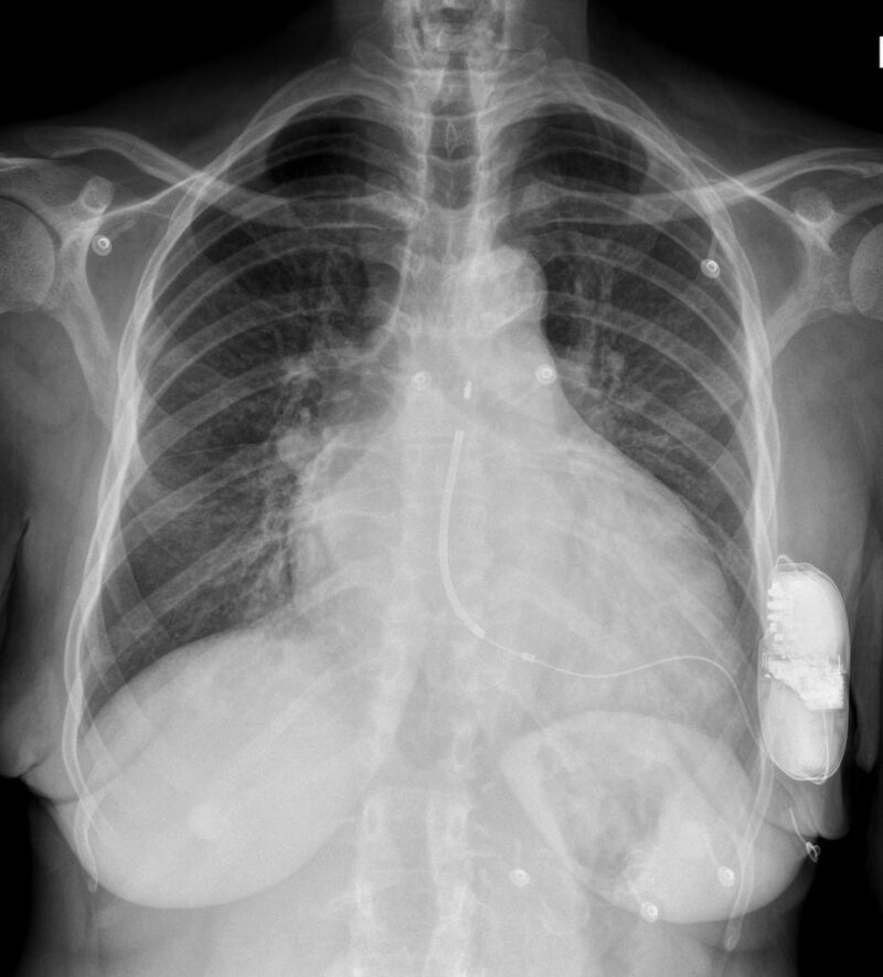 Abandoned Subcutaneous ICD Lead - MR IMPLANT