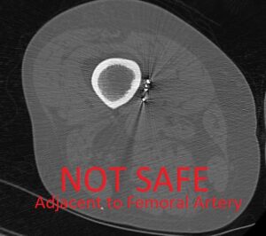 Bullets and Shrapnel - MR IMPLANT